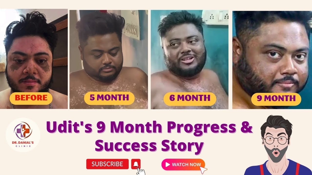 Udit’s Amazing Vitiligo Progress in 9 Months | Dr. Danial’s Clinic ...