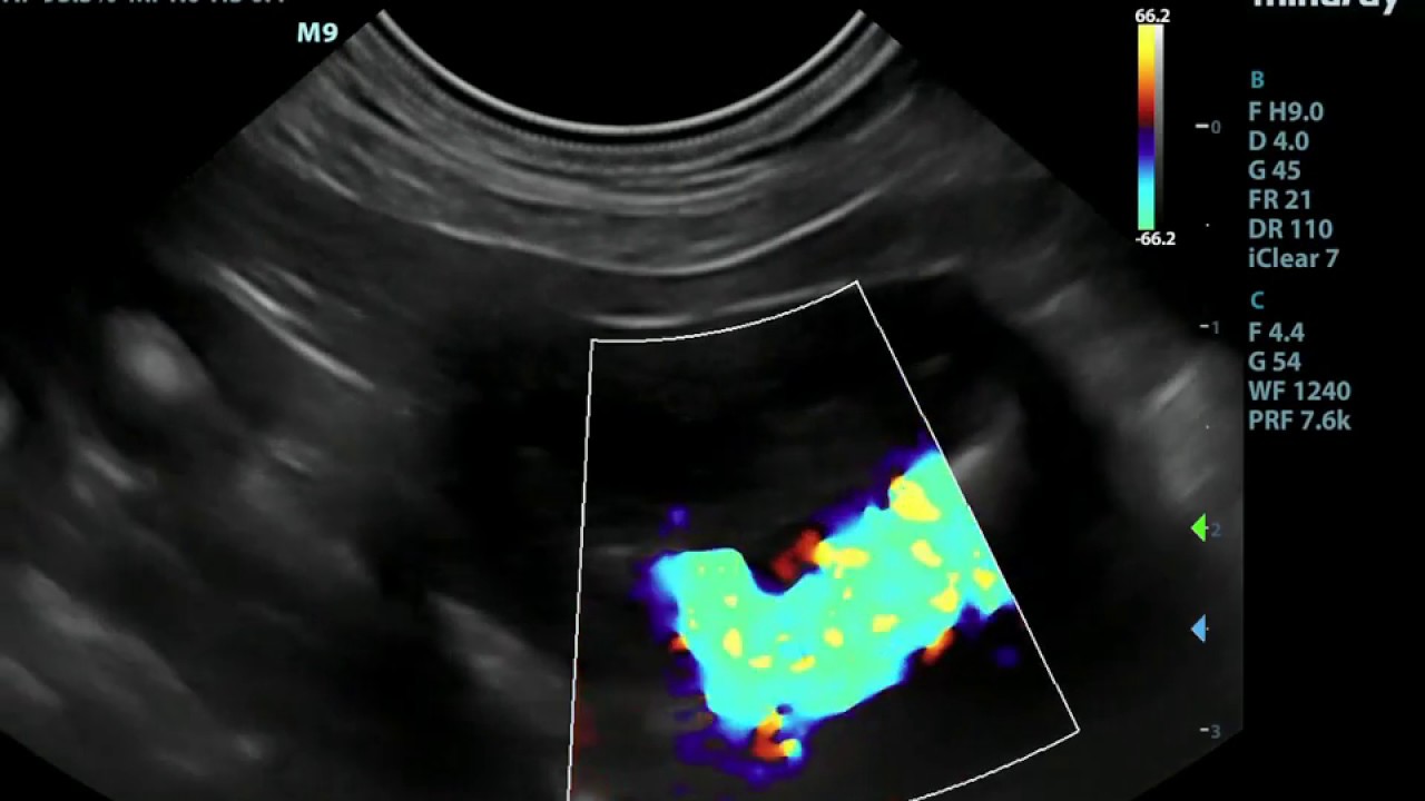 Small Animal Ultrasound - Twinkle Doppler artifact - YouTube