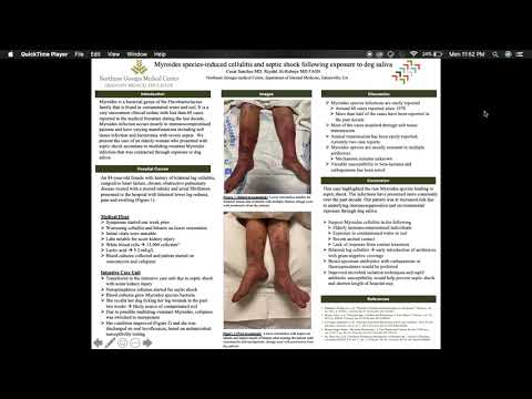 Myroides Species bilateral lower extremity cellulitis - YouTube