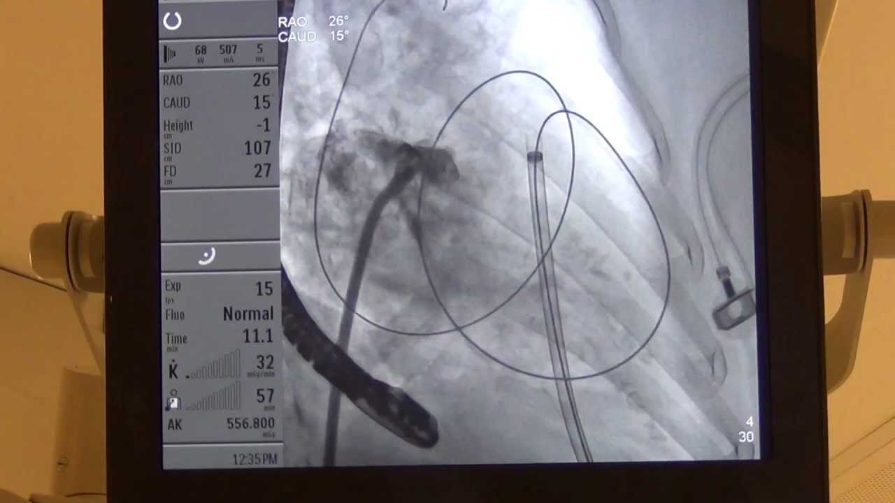 LARIAT Procedure Reduces the Risk of Stroke - YouTube