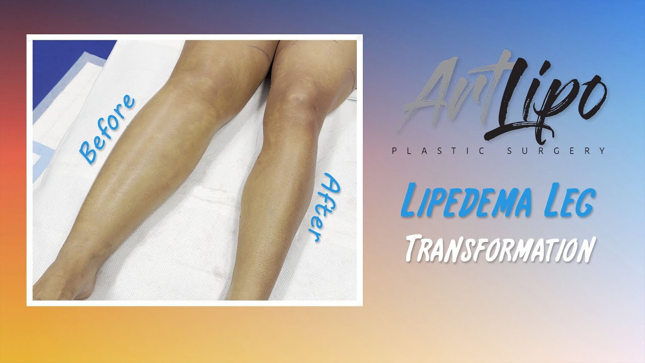 Cankles & Knees Liposuction | Lipedema Legs | Lipo 360° | Expert Dr ...
