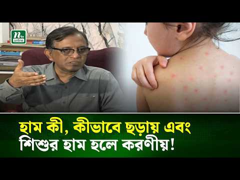 হাম কী, কেন ও কীভাবে ছড়ায় এবং শিশুর হাম হলে করণীয়! | NTV News