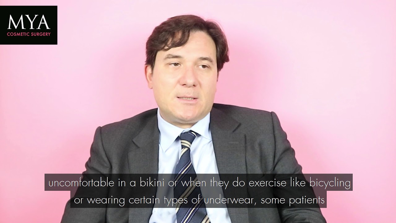 What Is A Labiaplasty? || Ask The Expert Surgeon - Mr Mileto - YouTube