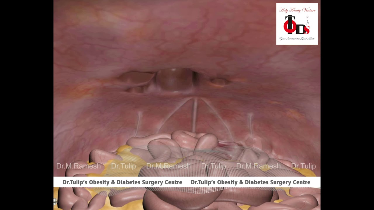 Swiss Cheese Hernia: Uncover Signs, Causes & Treatment Now ...