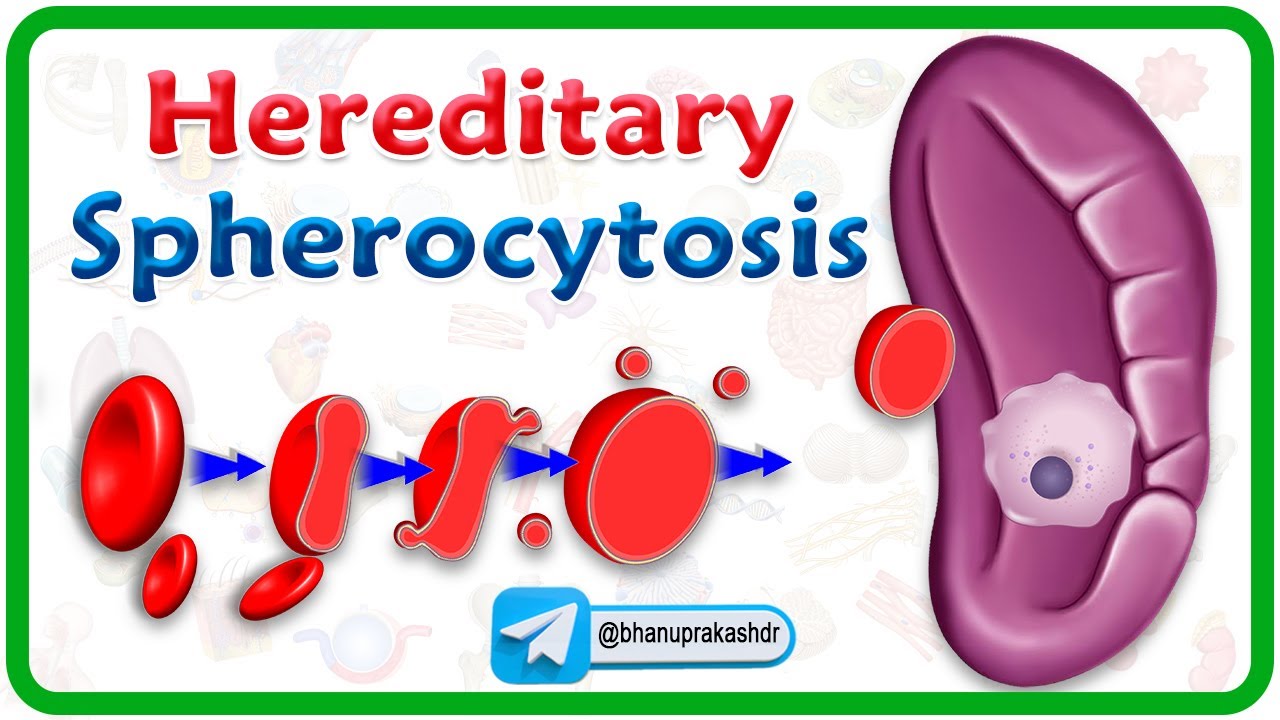 Hereditary Spherocytosis Animation : Etiology, Pathogenesis, Clinical features, Diagnosis ...