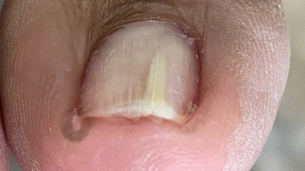 Impacted ingrown toenail #impactedtoenail #ingrown_toenail #pedicure # ...