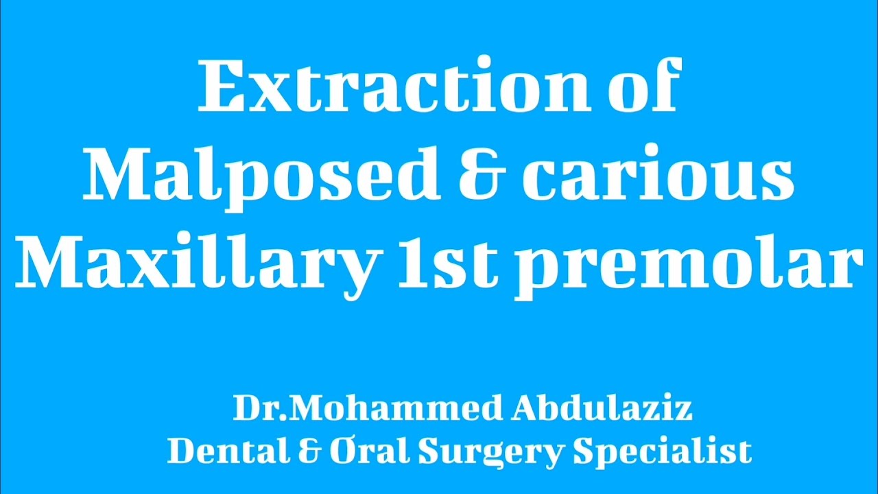Extraction of Malposed & carious Maxillary 1st premolar - YouTube