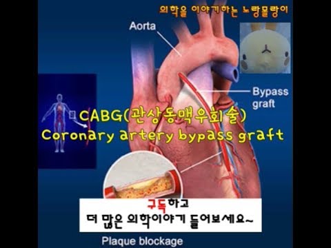 CABG (관상동맥우회술, coronary artery bypass grafting) 전반적 이해 - YouTube