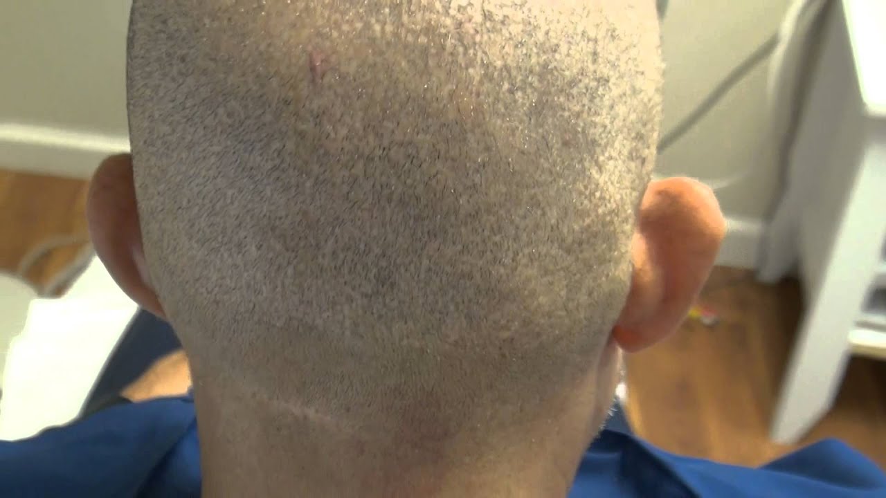 FUE Scar After 2 Hair Transplant Surgeries Follicular Unit Extraction ...