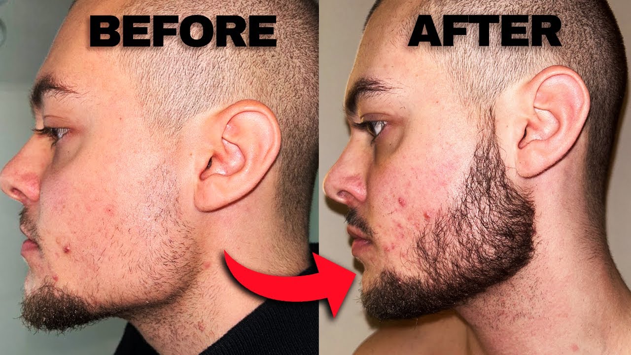 Minoxidil Beard Before And After - 2 Months Progress - YouTube