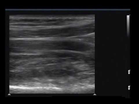 Suprascapular Nerve Block - YouTube