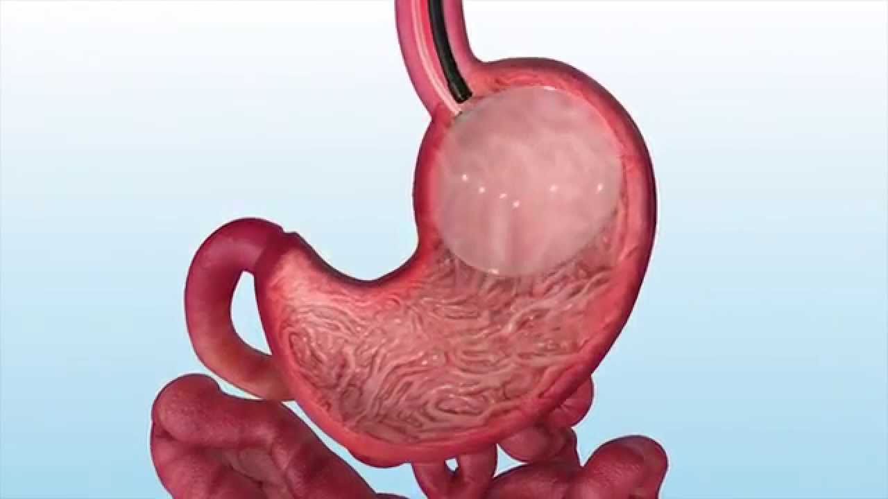 Intragastric Balloon Procedure | The Longstreet Clinic - YouTube