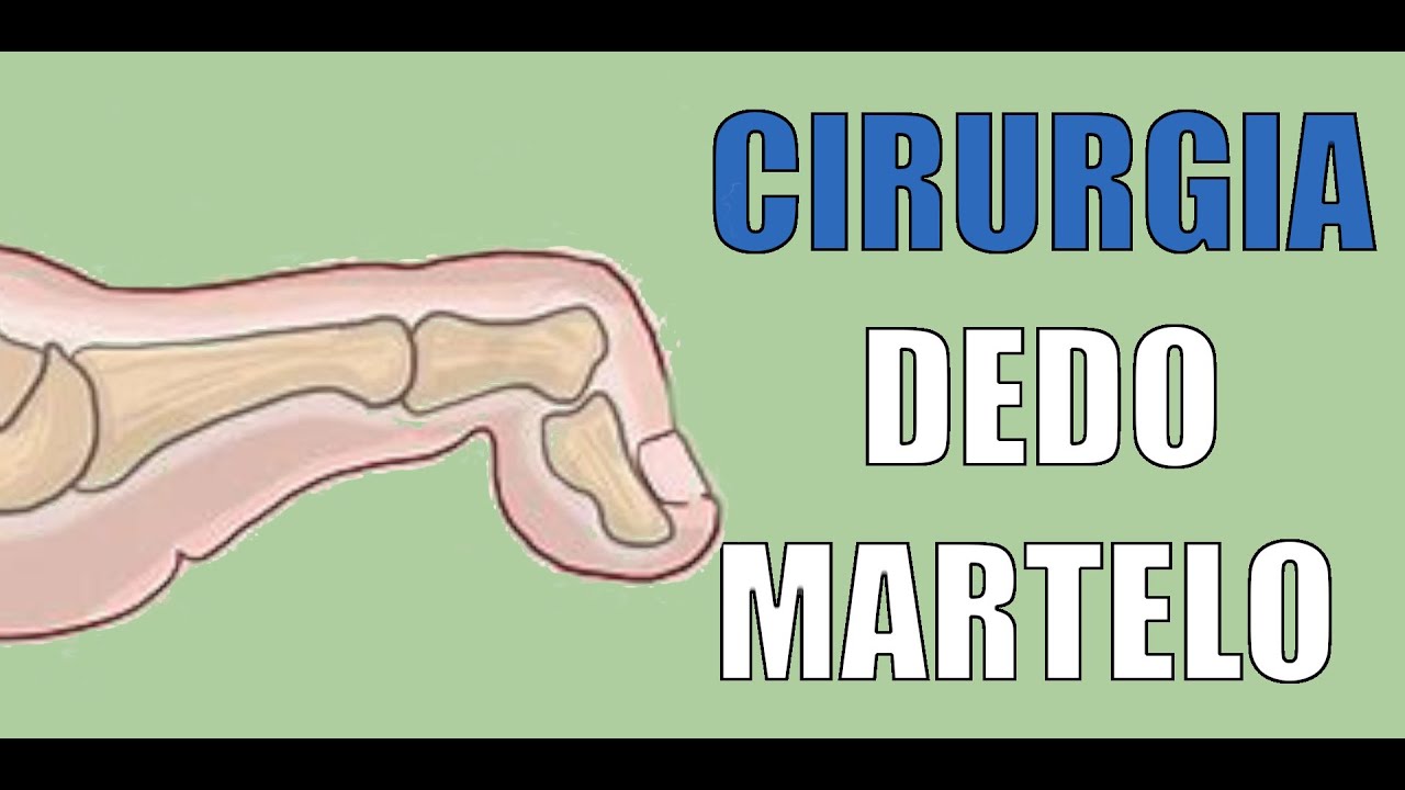 Como é feita a #Cirurgia do #dedo #martelo do pé - #saúde - YouTube