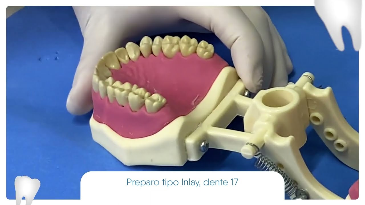 Preparo: Inlay Metálica - YouTube