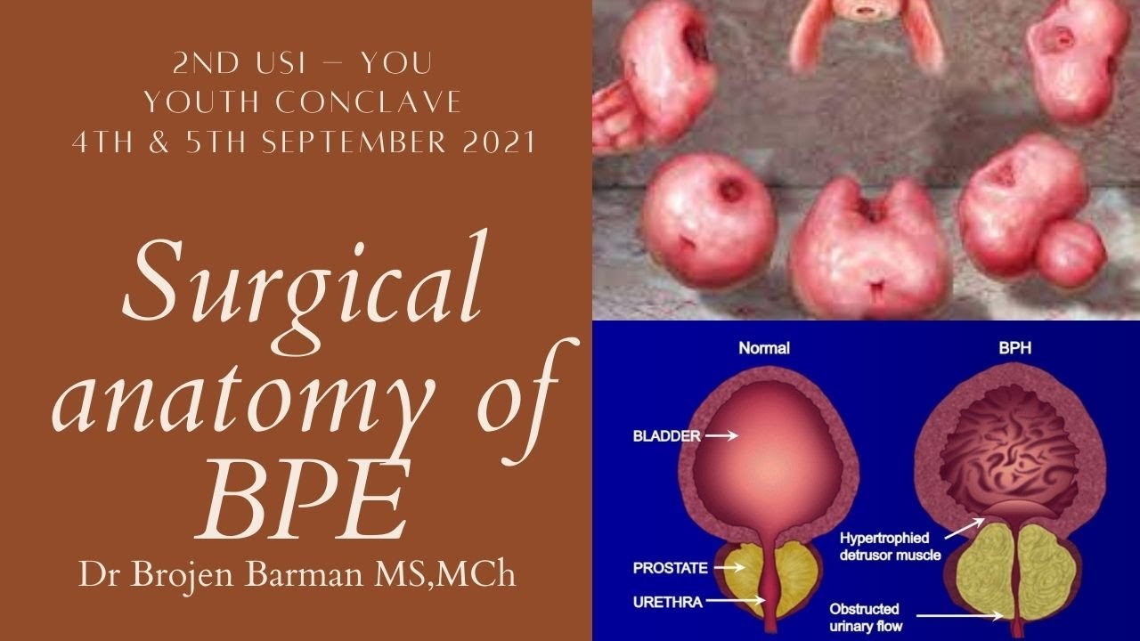 PROSTATE ANATOMY | DR BROJEN BARMAN MCh - YouTube