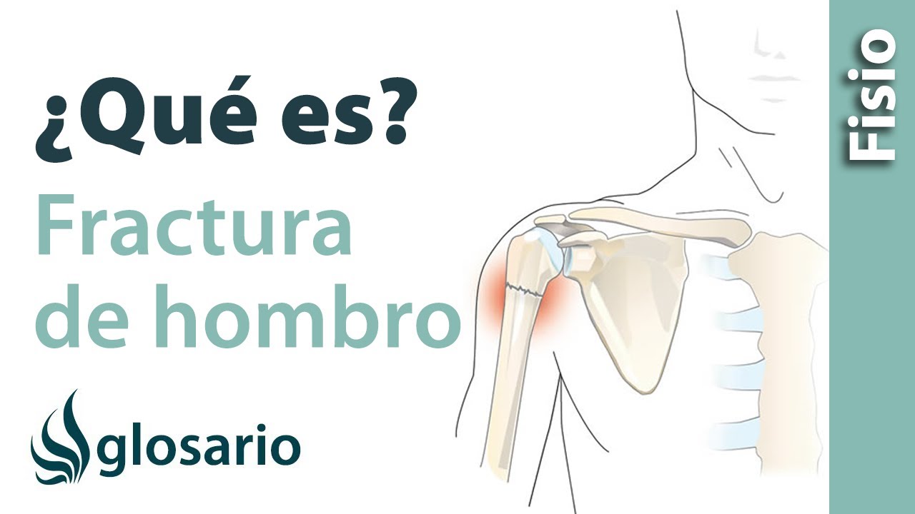 FRACTURA DE HOMBRO | ¿Qué es? - YouTube