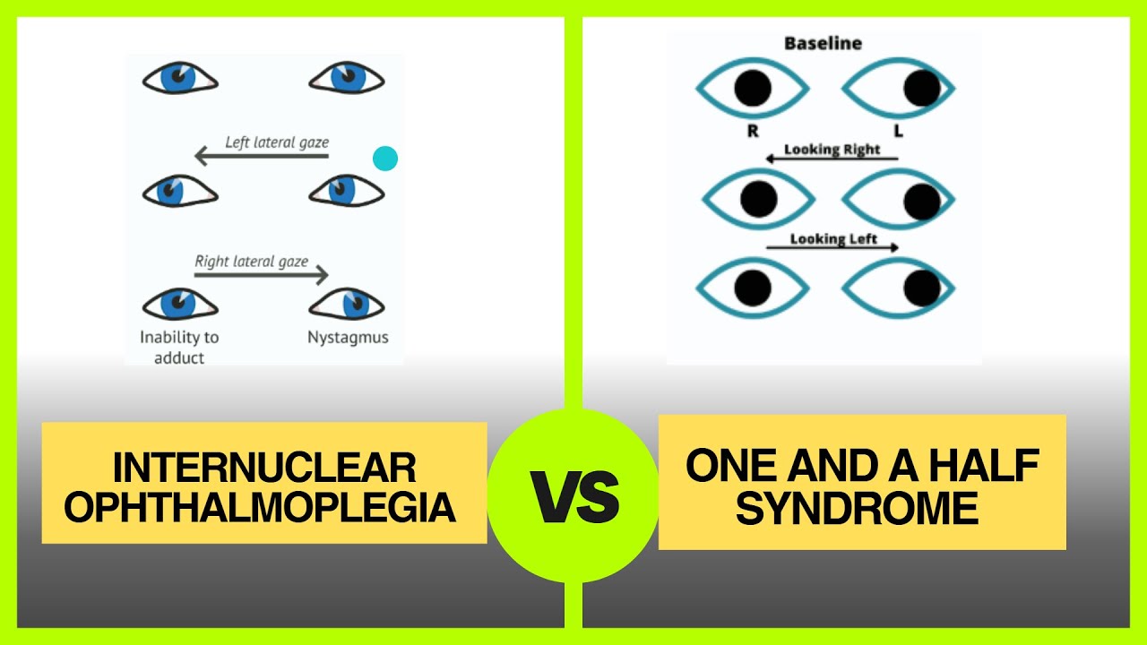 Internuclear ophthalmoplegia and One and Half syndrome - YouTube