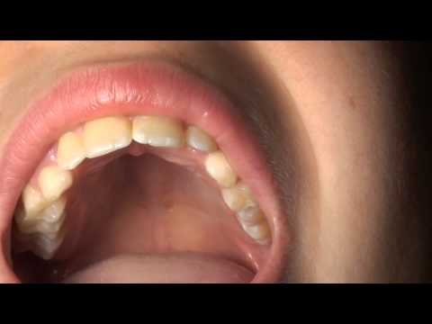 Palatal Myoclonus -Bilateral tremors of the soft palate - YouTube
