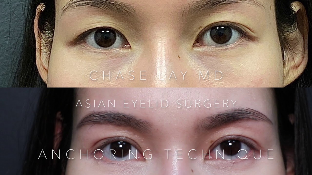 Asian eyelid surgery Anchoring Chase Lay MD 2020 - YouTube