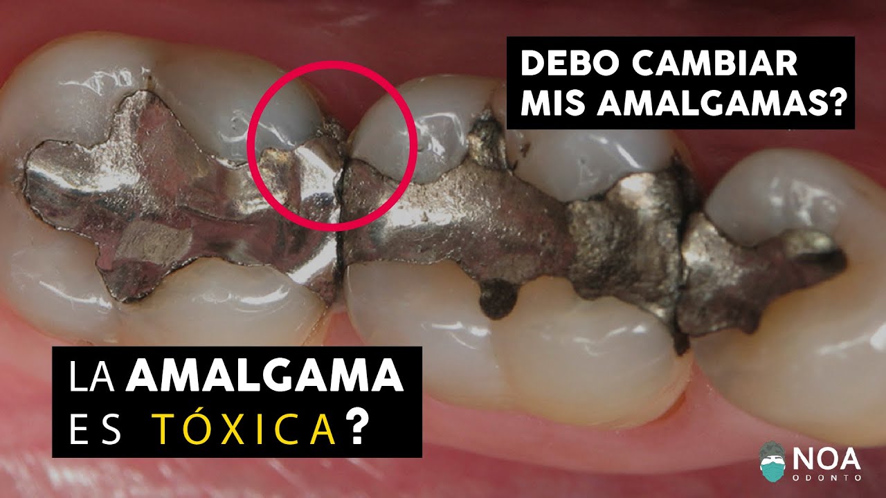 ¿LA AMALGAMA ES TOXICA? ¿DEBO CAMBIAR MIS AMALGAMAS? - YouTube