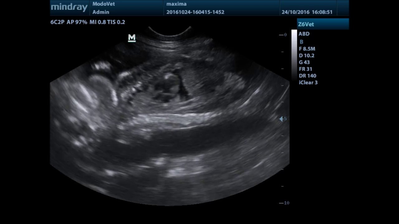 Anasarca fetal - YouTube