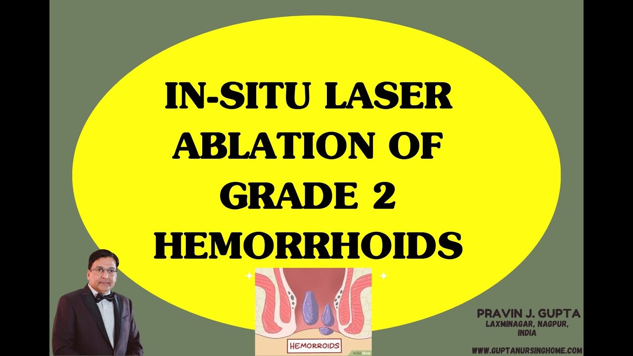 IN-SITU ABLATION OF GRADE TWO HEMORRHOIDS BY DIODE LASER - YouTube