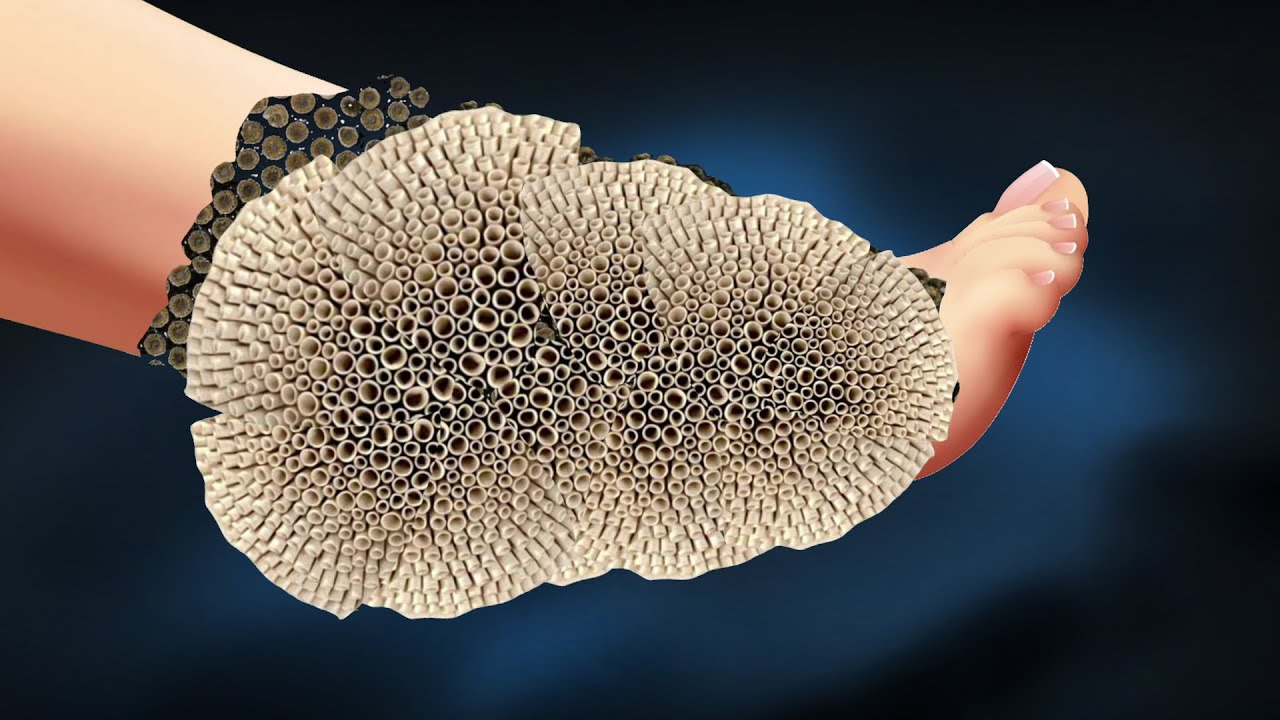 ASMR Remove Worm & Maggots Infected Foot | ASMR Treatment Animation ...