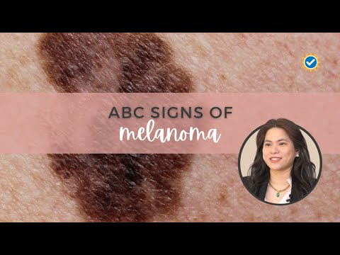 The ABC signs of melanoma - Dr Angelica Logarta-Scott - YouTube
