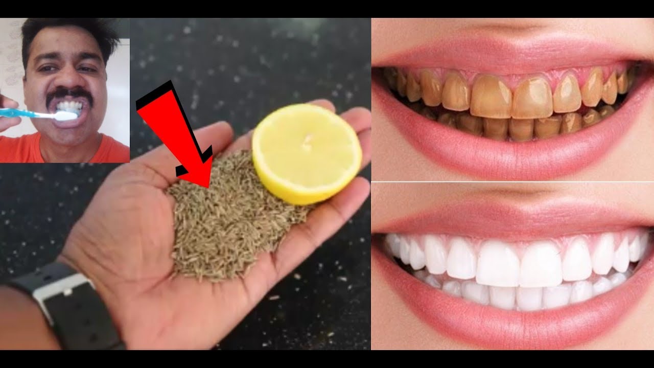 അഞ്ചുമിനിറ്റില്‍ പല്ലിലെ കറകളയാം | Just 5 Minutes Teeth Whitening - YouTube
