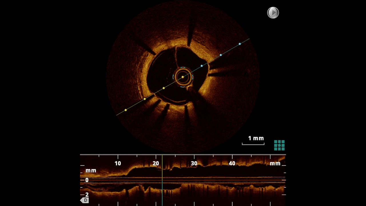 Utility of OCT in Left Main stem PCI - YouTube