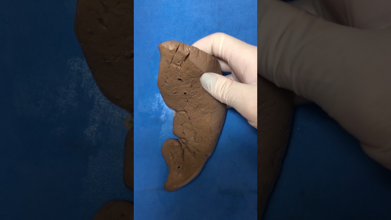 Necrose por esfacelo - YouTube