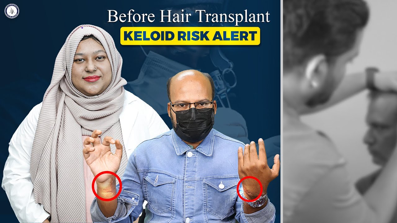 Before Hair Transplant, Watch This | Keloid Risk Alert ⚠️ | Bangladesh ...