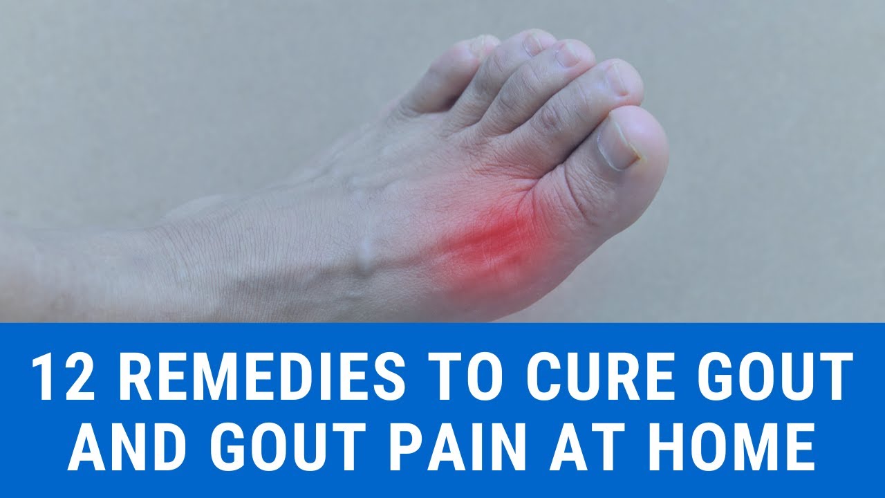 Gout Remedies - 12 Remedies To Cure Gout And Gout Pain At Home - YouTube