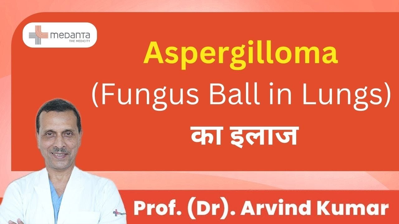 Aspergilloma (Fungus Ball) का इलाज क्या है ? | Thoracic Surgeon | Prof ...