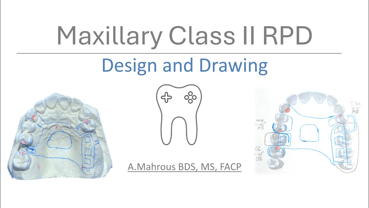 Maxillary Class II RPD Design: Step-by-Step Guide to Surveying ...
