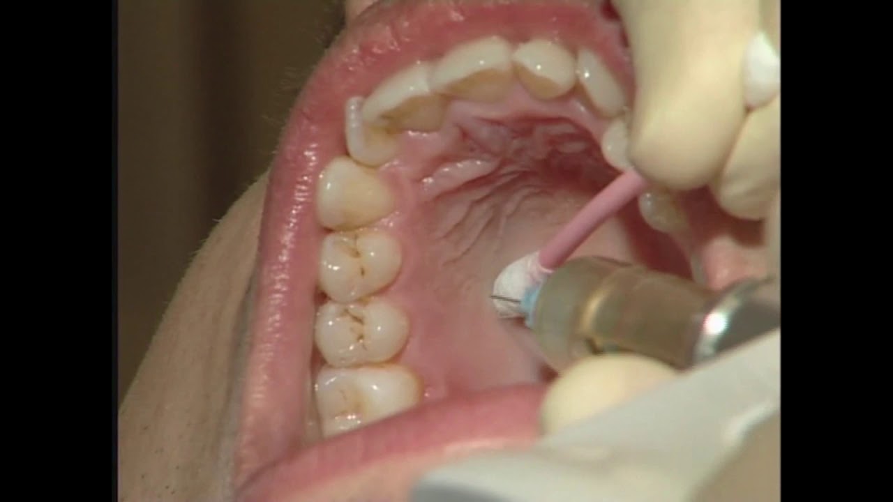 Palatal anesthesia - YouTube