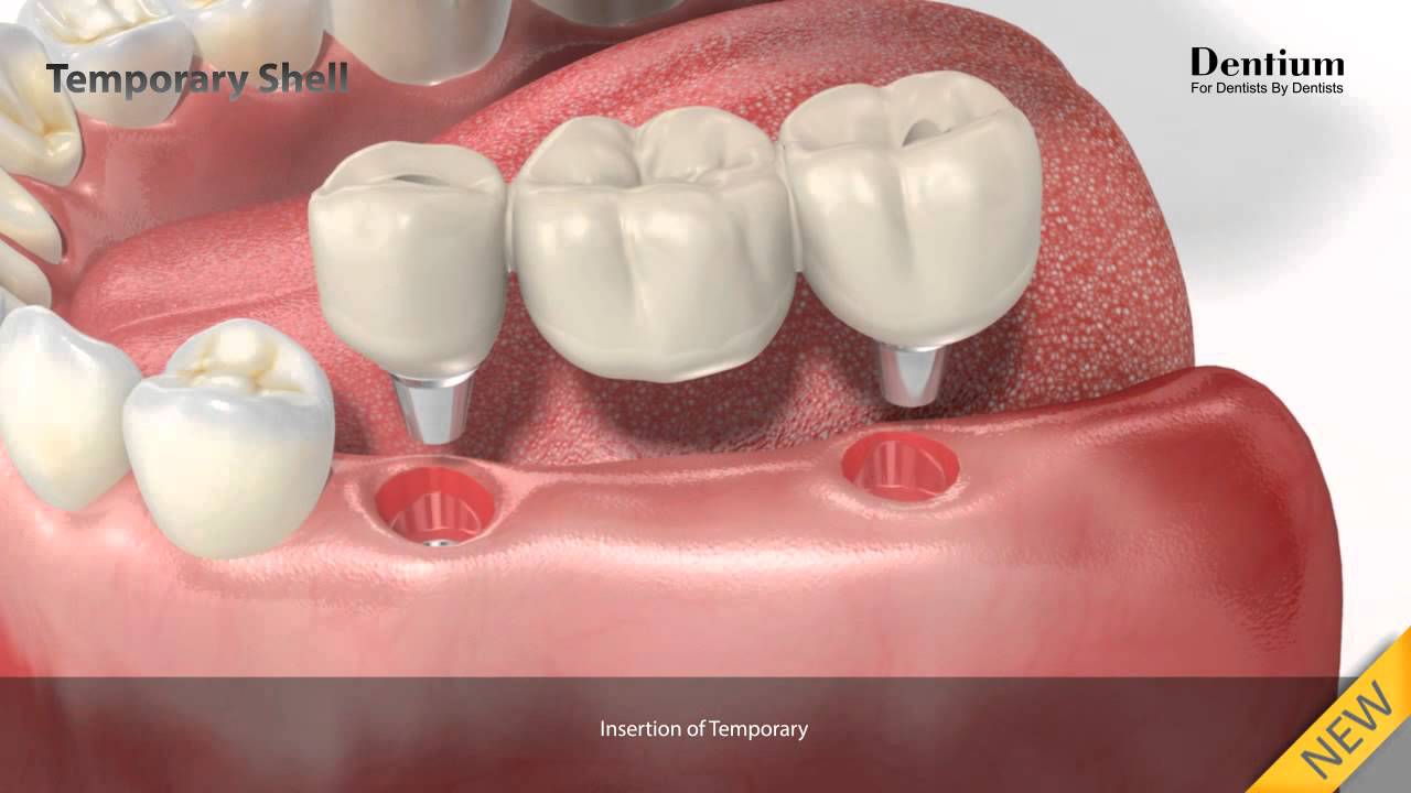 Temporary Shell 3D VOD - YouTube