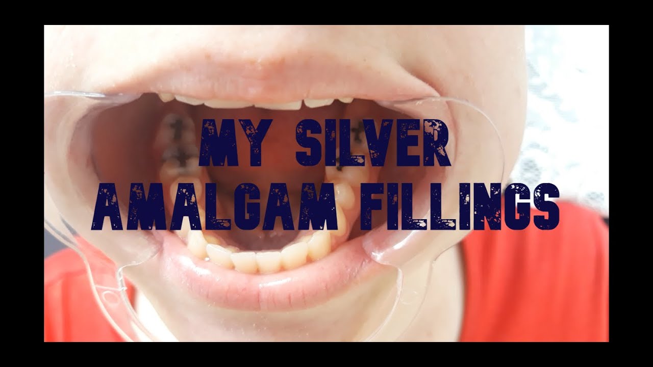 MY 7 SILVER AMALGAM TOOTH FILLINGS - YouTube