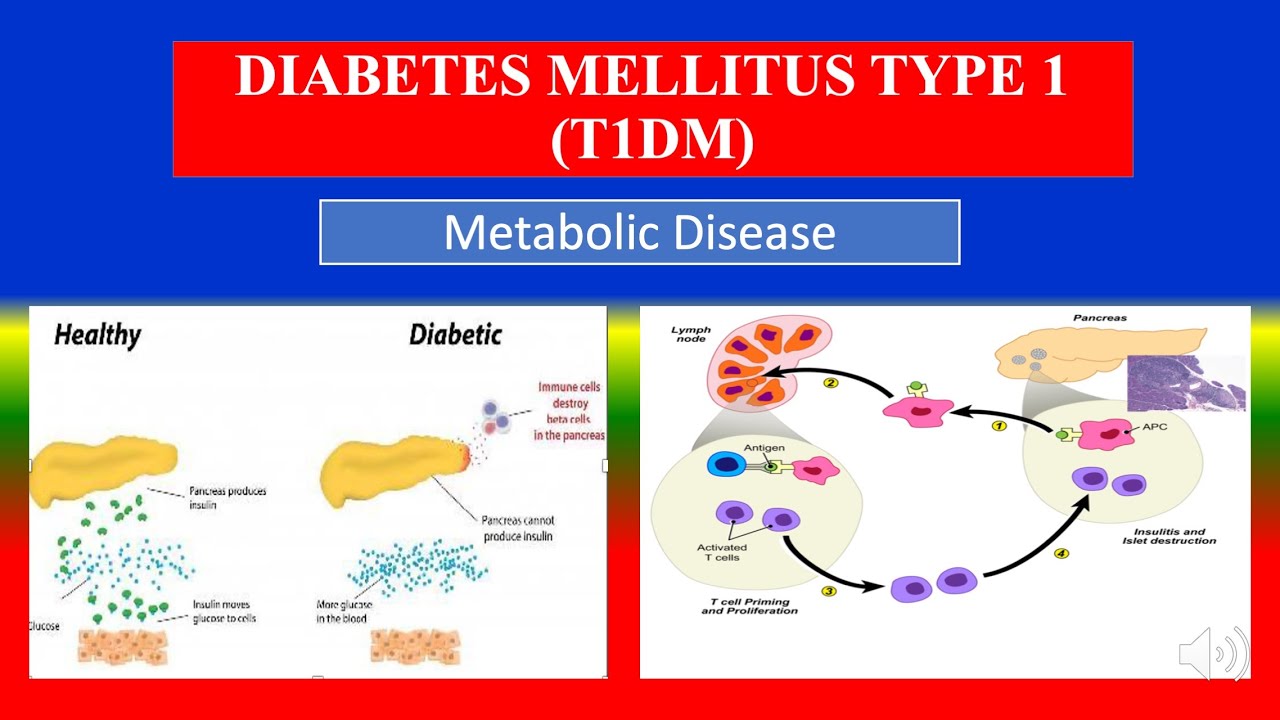 DIABETES MELLITUS TYPE 1 (T1DM) - Definition, types, cusses ...