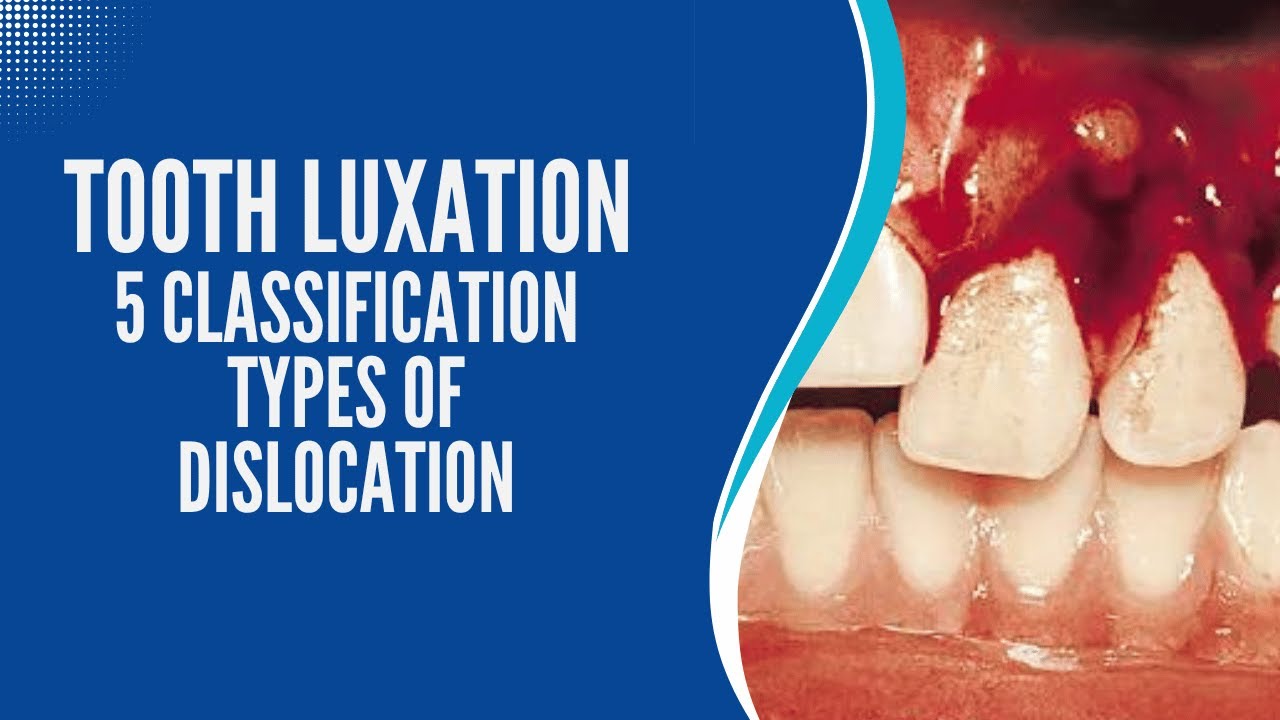 Tooth Luxation: 5 Classification Types of Dislocation - YouTube