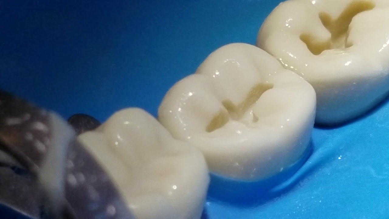 How to prep class I Cavity on #18 - YouTube