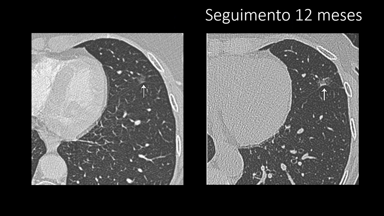 cancer pulmão - YouTube