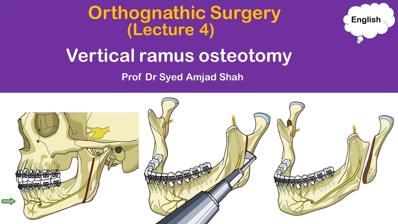 Vertical ramus osteotomy | Orthognathic Surgery | Oral & Maxillofacial ...