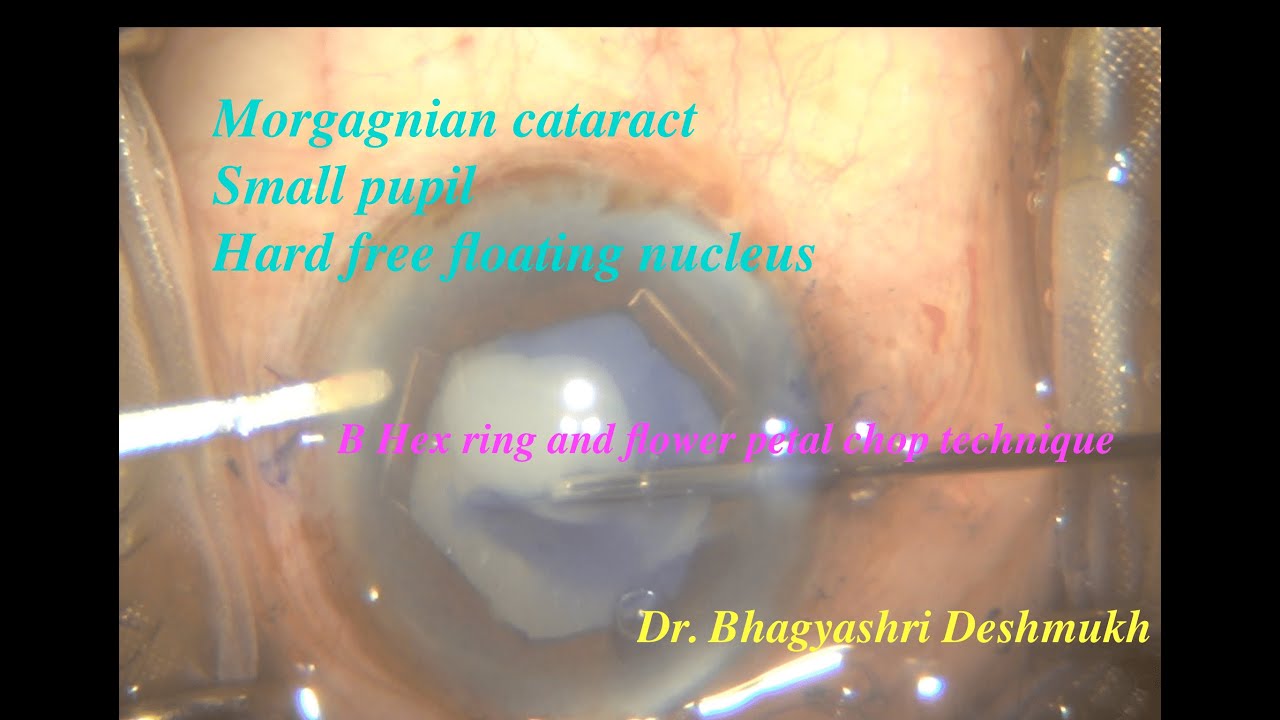 Morgagnian cataract, small pupil..managed with BHex ring and flower ...