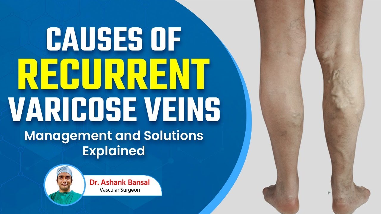 Prevent Varicose Veins from Recurring: Tips and Techniques by Dr ...