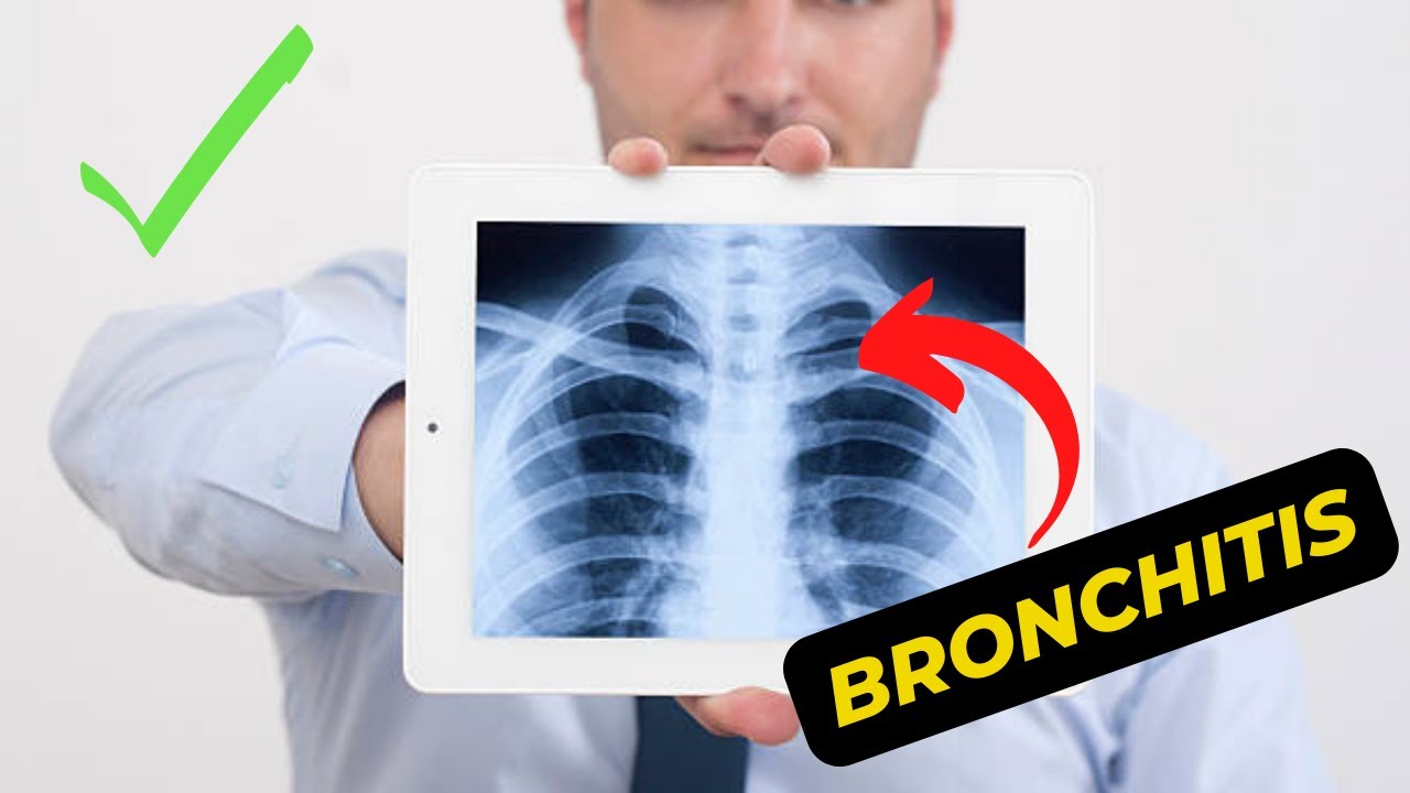 How to Treat Bronchitis: Natural Remedies and Practical Tips - YouTube