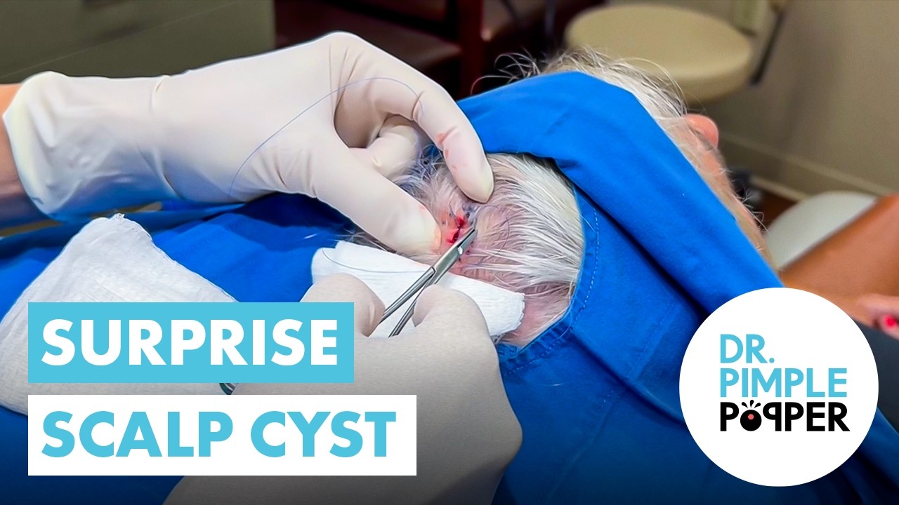 A Surprise Scalp Cyst - YouTube