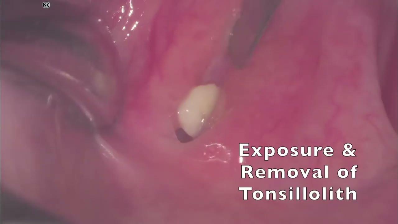Laser Ablation Tonsil Crypts - YouTube