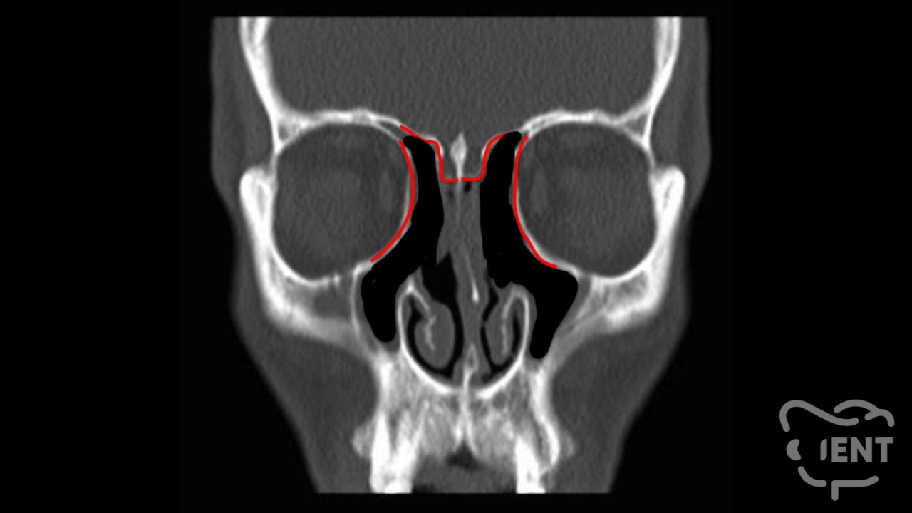 PLANIFICACIÓN QUIRÚRGICA EN CIRUGÍA DE ETMOIDES - YouTube