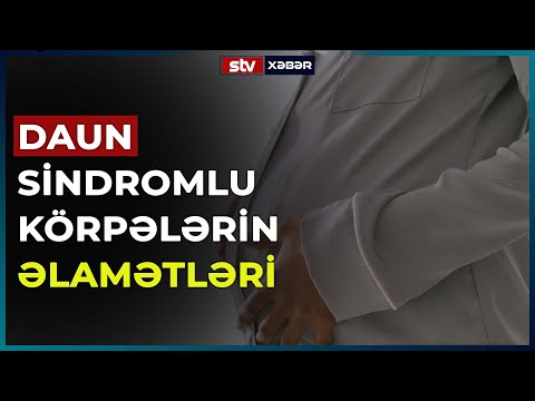 DAUN SİNDROMLU KÖRPƏLƏRİN ƏLAMƏTLƏRİ - STV XƏBƏR